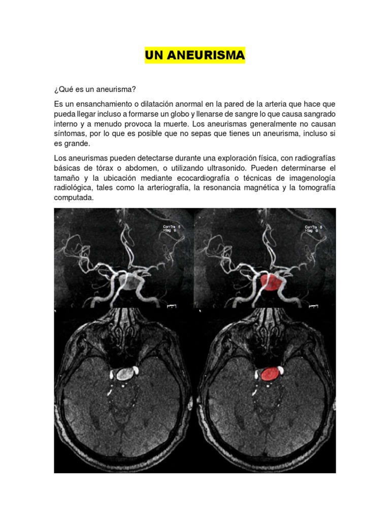 ANEURISMA | PDF