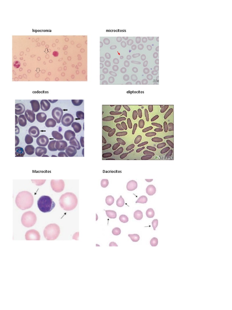 Anormalidades de Los Eritrocitos | PDF