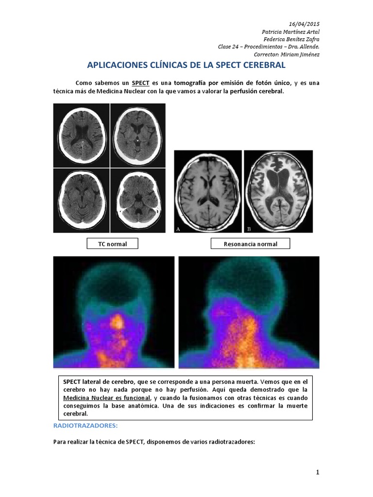 SPECT Cerebral | PDF