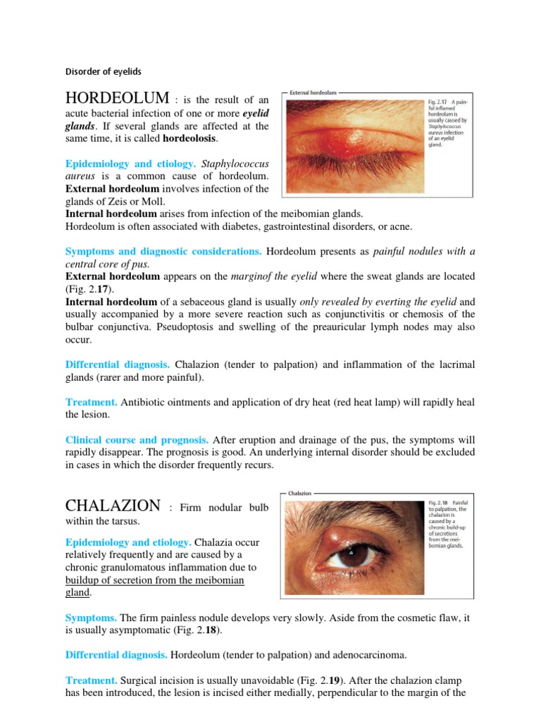 Disorder of Eyelids | Immunology | Diseases Of The Eye And Adnexa