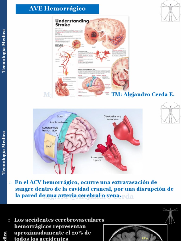 ACV Hemorrágico: Clasificación y Diagnóstico | PDF