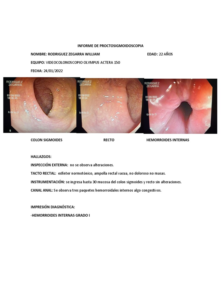Informe de Proctosigmoidoscopia | PDF