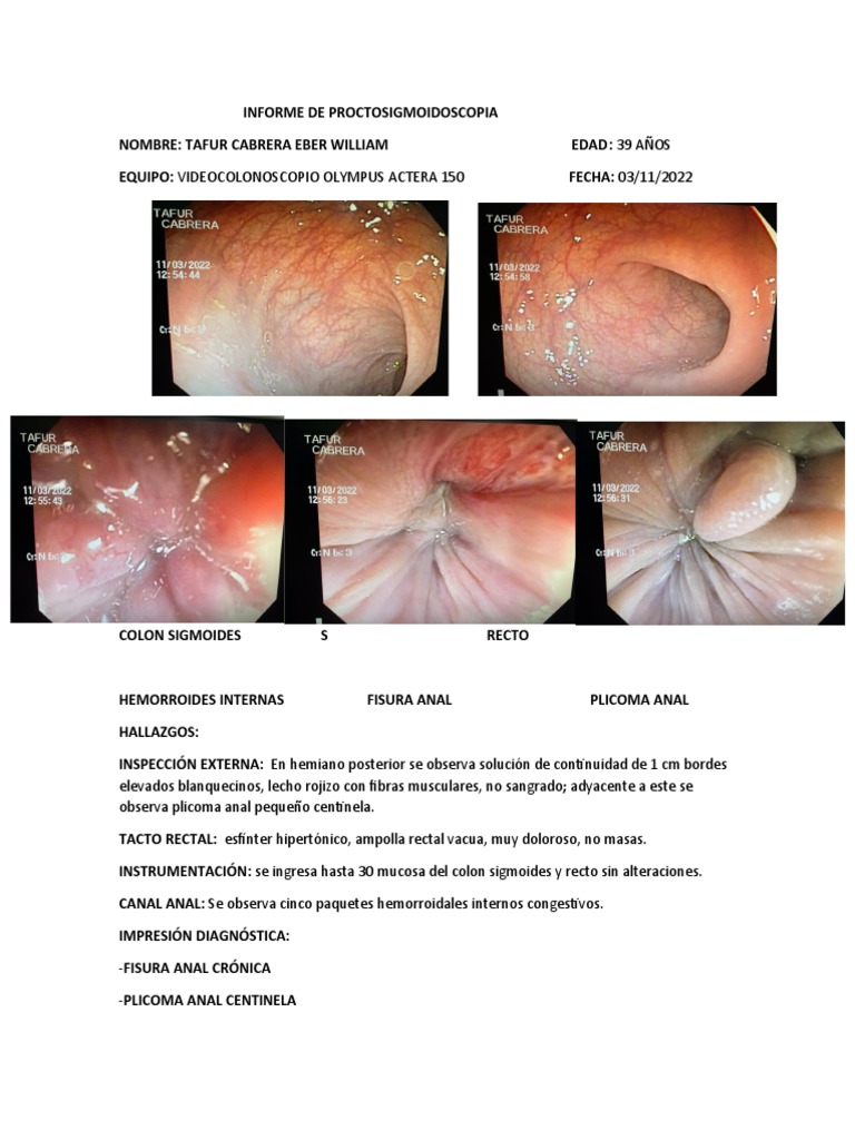 Informe de Proctosigmoidoscopia Tafur | PDF