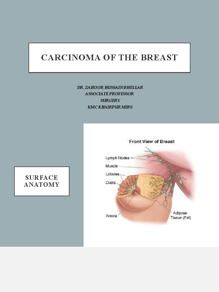 Carcinoma of The Breast | PDF | Breast Cancer | Mastectomy