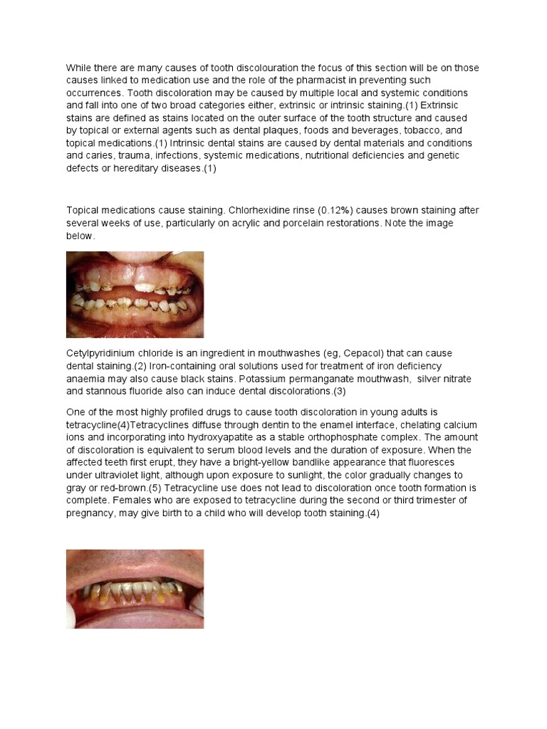 Tooth Discolouration | PDF
