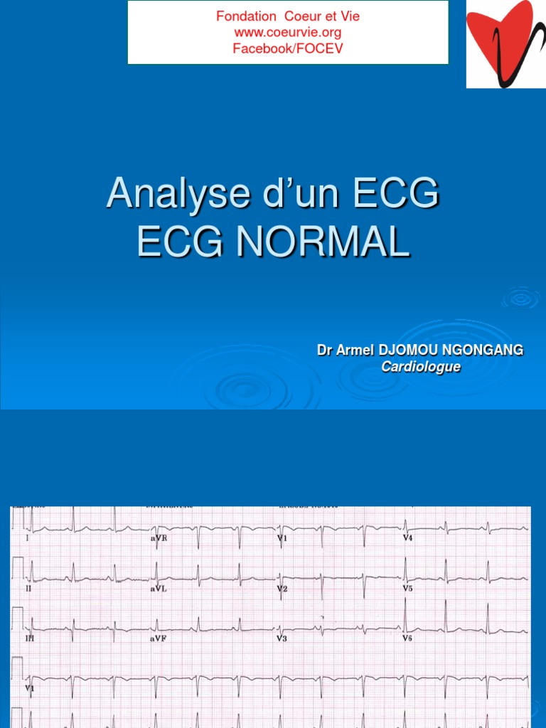 1analyse D'un Ecg Et Cas Patho 2020 | PDF