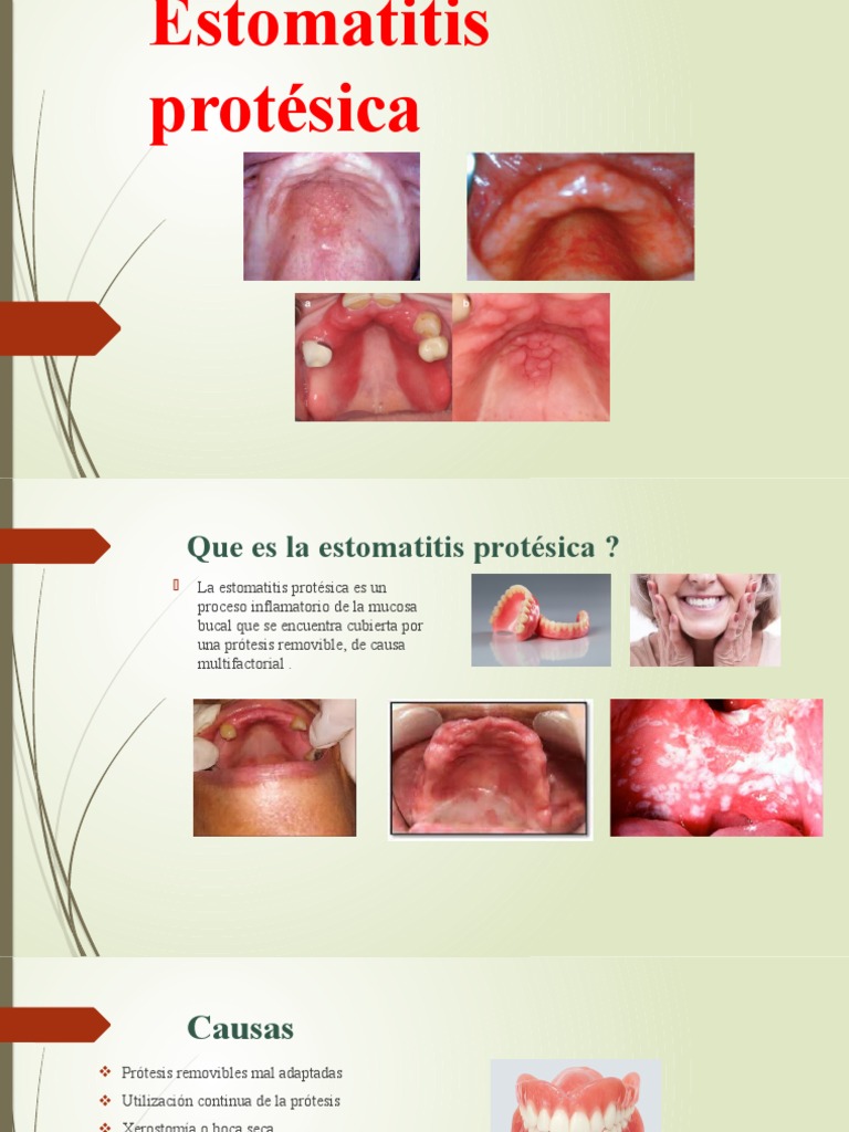 Estomatitis protésica | PDF