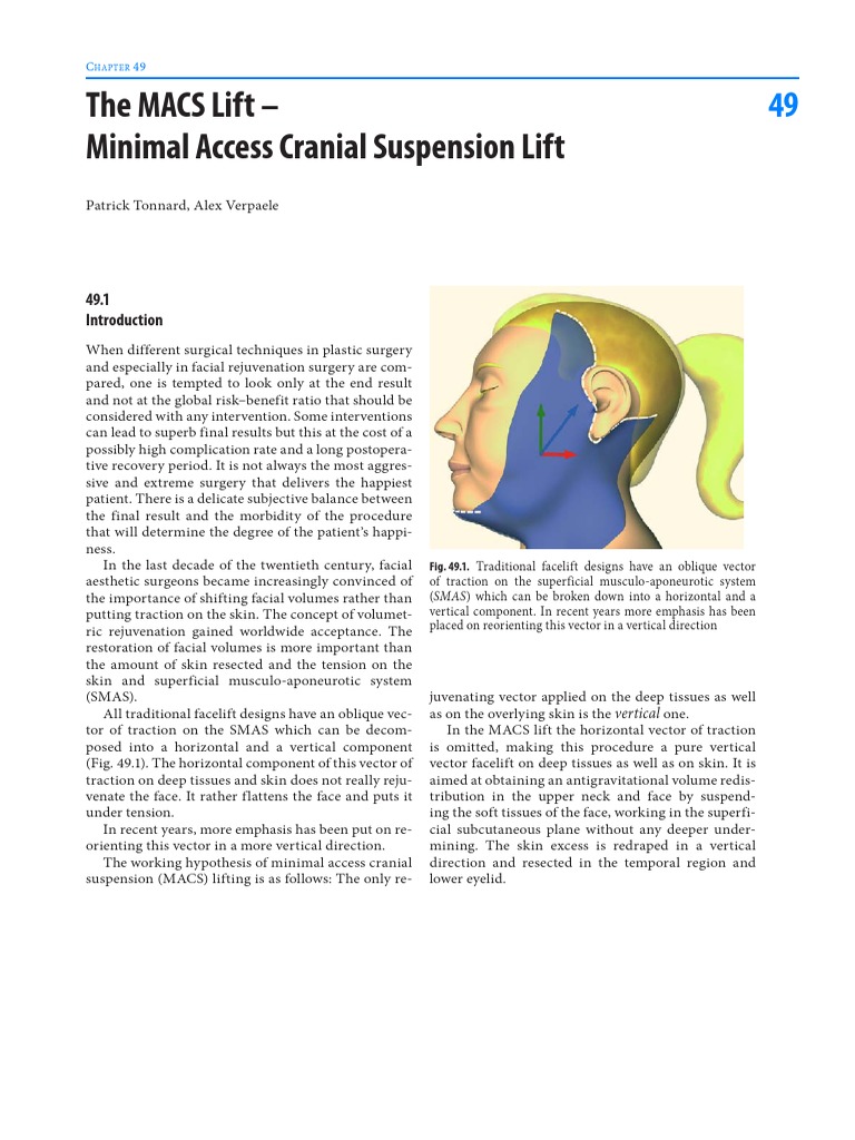 The MACS Lift - Minimal Access Cranial Suspension Lift: Hapter | PDF