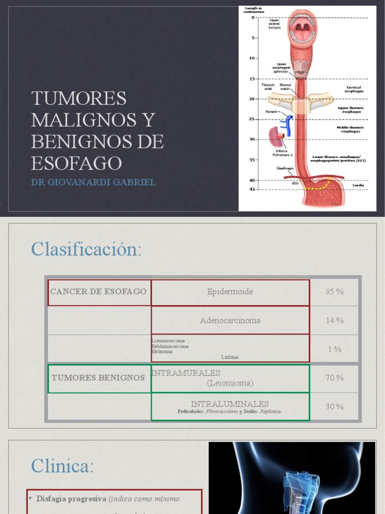 Tumores Benignos y Malignos de Esofago. PP | PDF | Cáncer de esófago ...