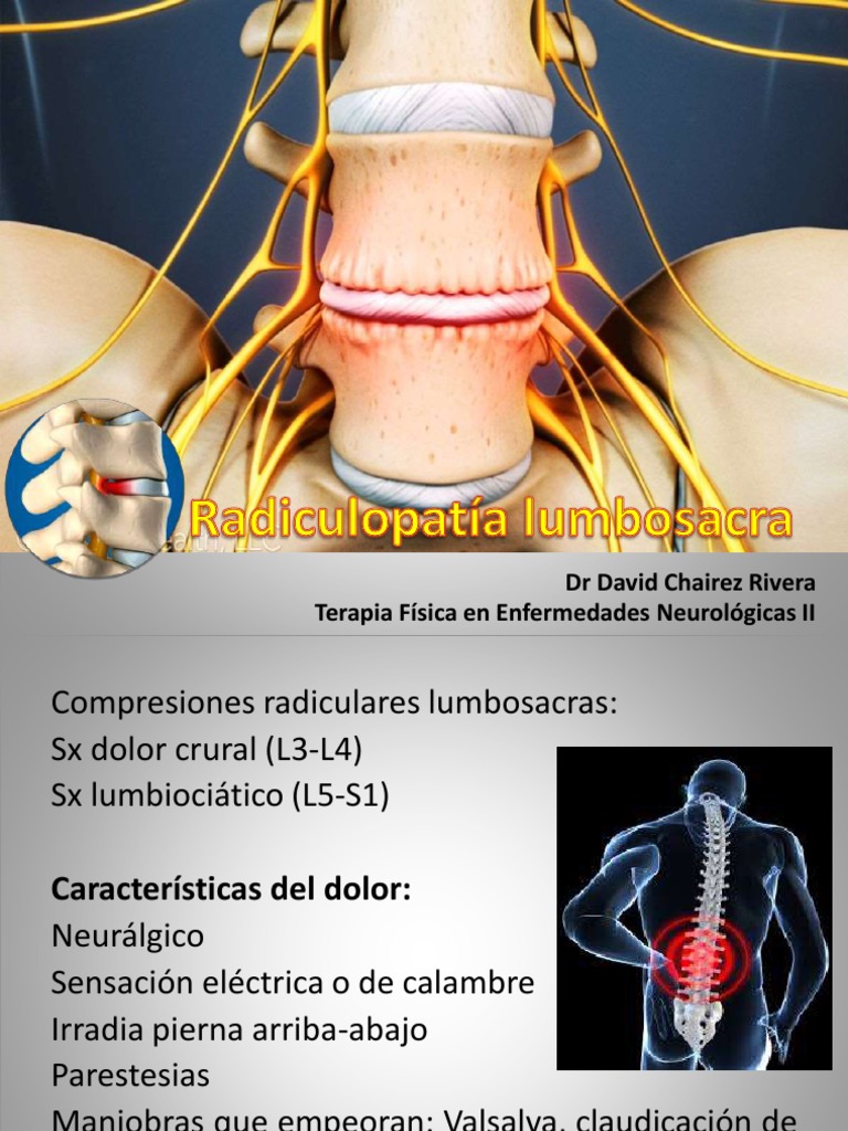 26 Radiculopatía Lumbosacra DR Chairez | PDF