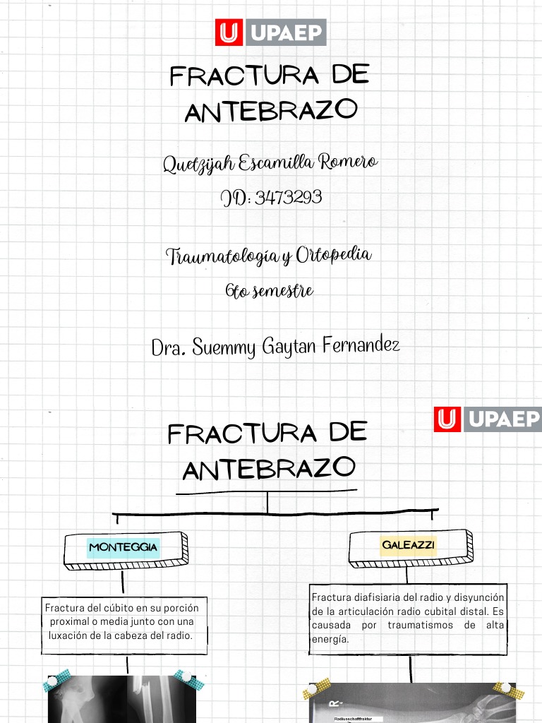 Fractura De Antebrazo Descargar Gratis Pdf Biomecánica