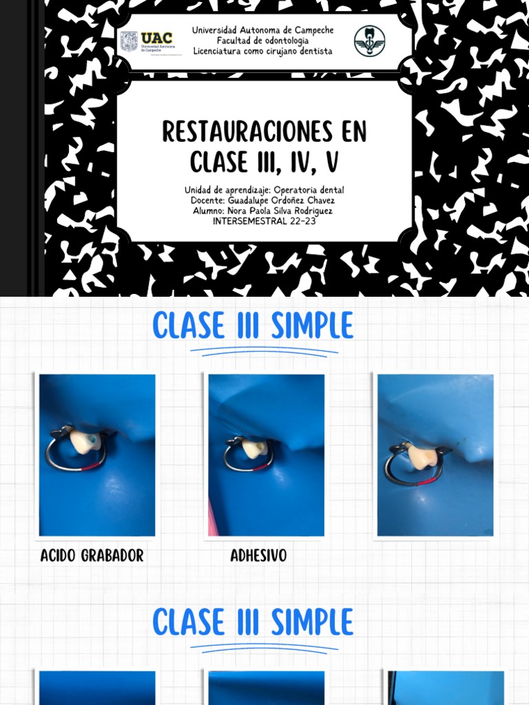Restauraciones Dentales en Clases III-V | PDF