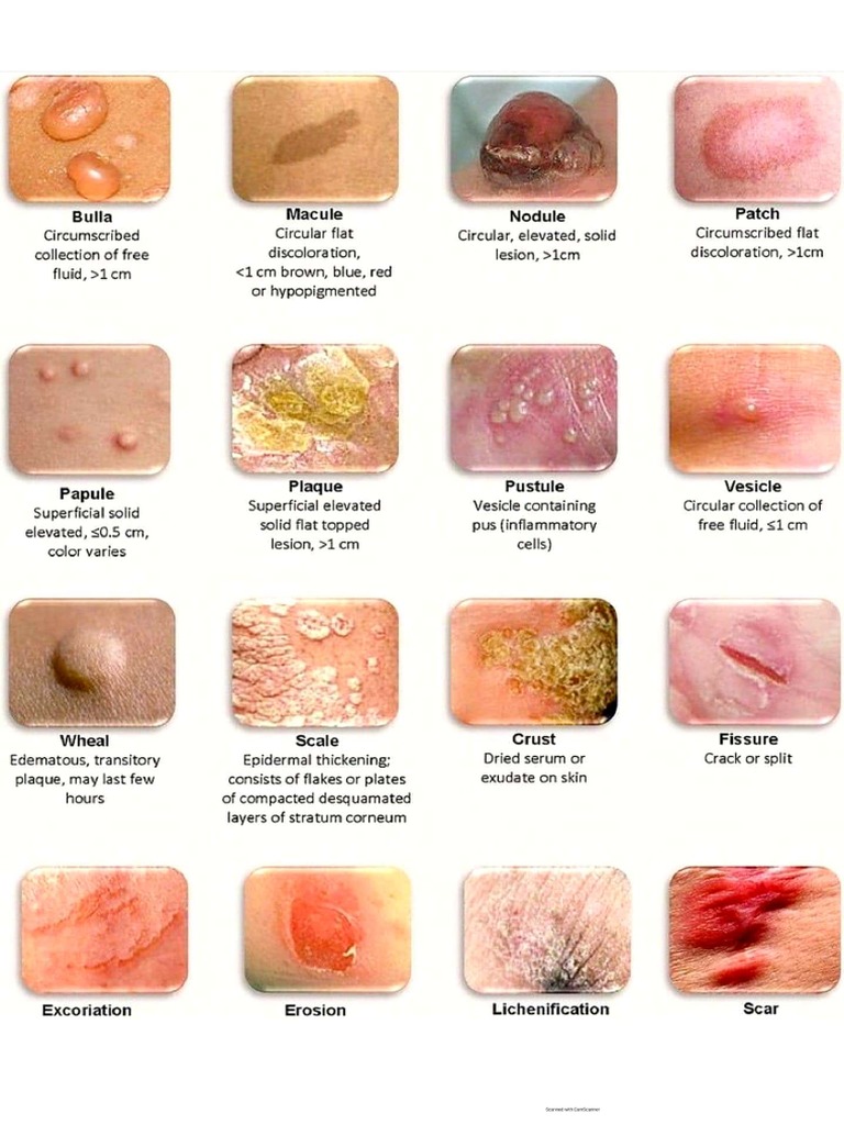 Different Types of Skin Lesions - Dermatology | PDF