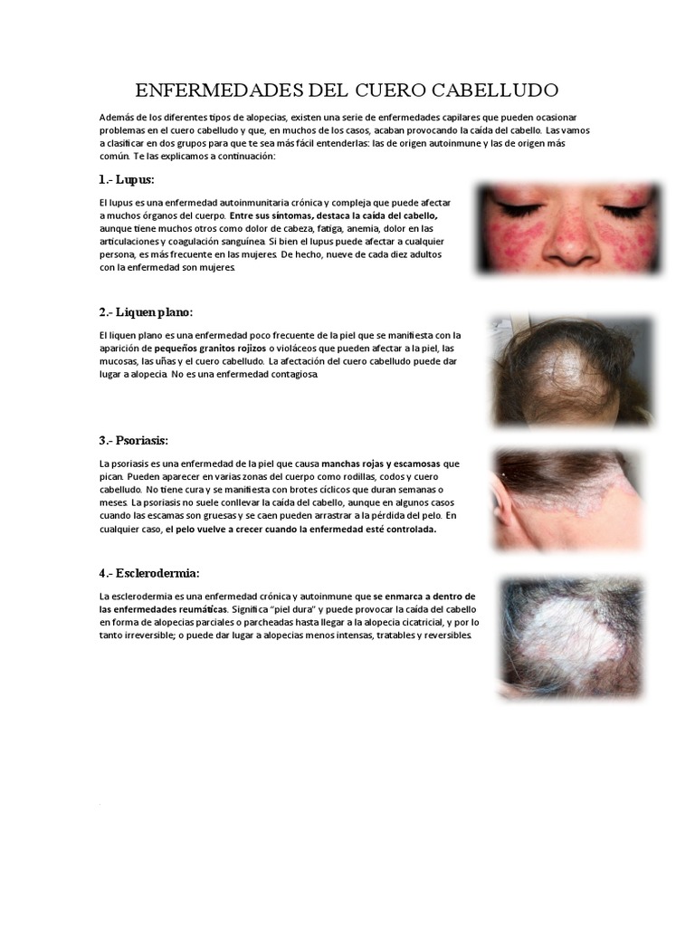 Enfermedades Del Cuero Cabelludo | PDF