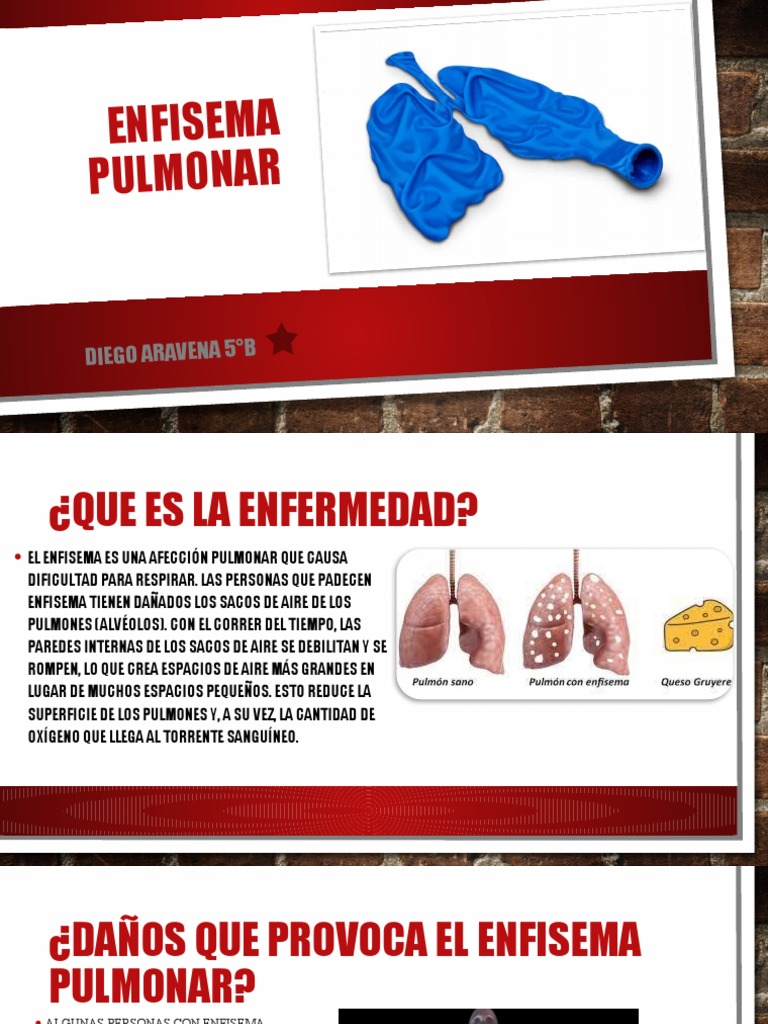 Síntomas y causas del enfisema pulmonar | PDF