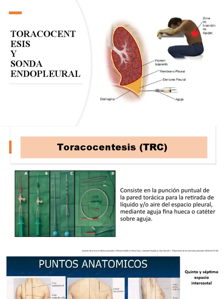 TORACOCENTESIS | PDF