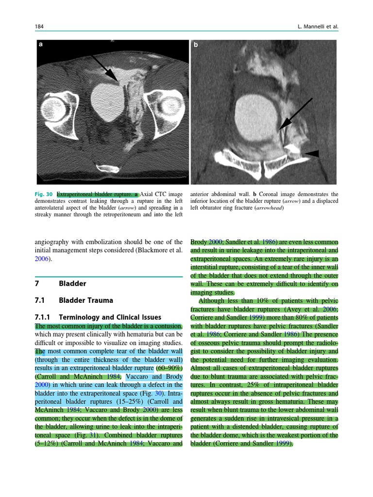 Intraperitoneal Bladder Rupture Insights | PDF | Peritoneum | Ct Scan