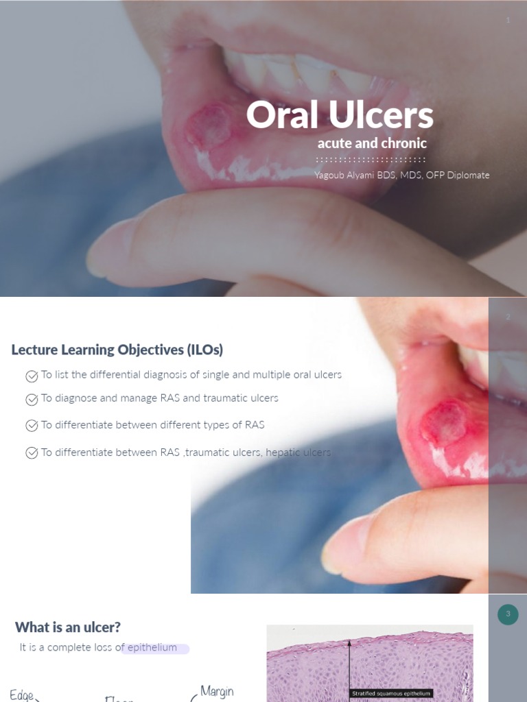 Oral Ulcers: Acute and Chronic | PDF | Gastroenterology | Immunology