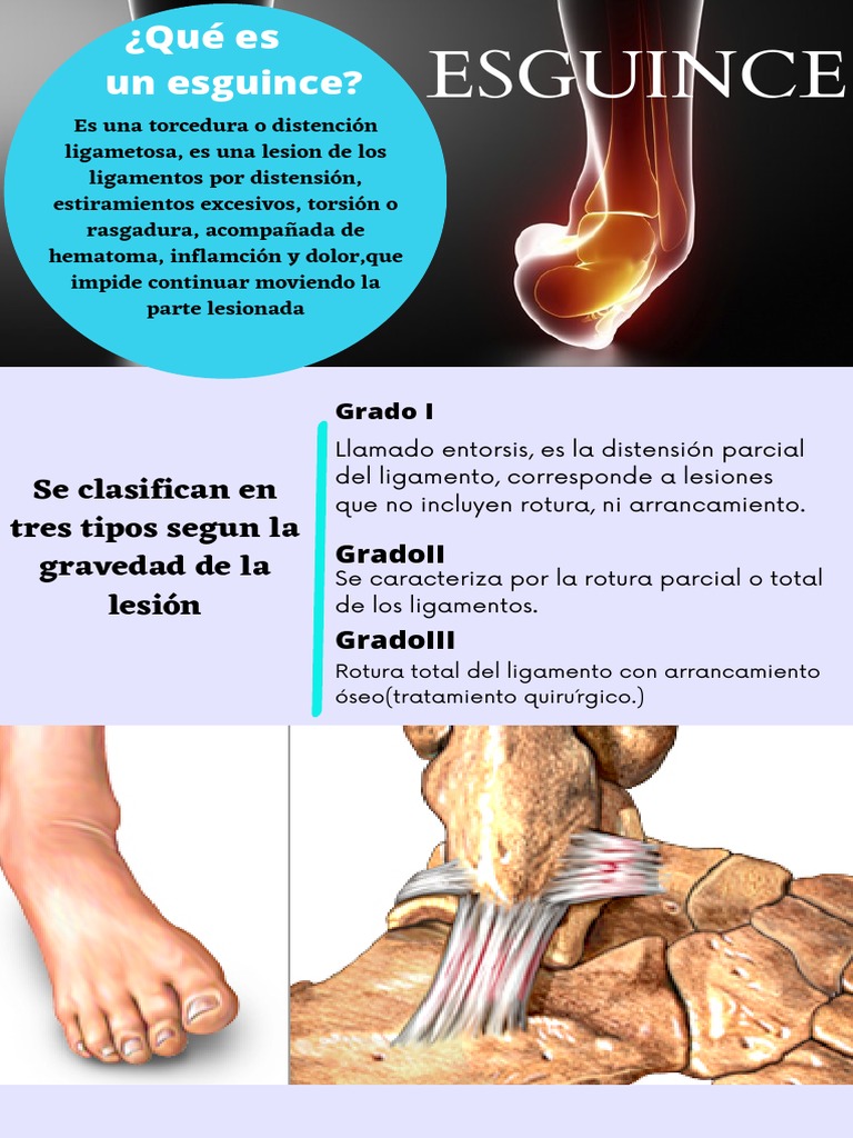 Guía Básica sobre Esguinces | PDF