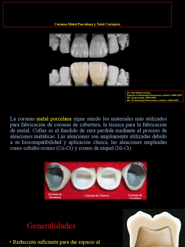 Comparativa de Coronas Metal Porcelana | PDF | Odontología | Materiales