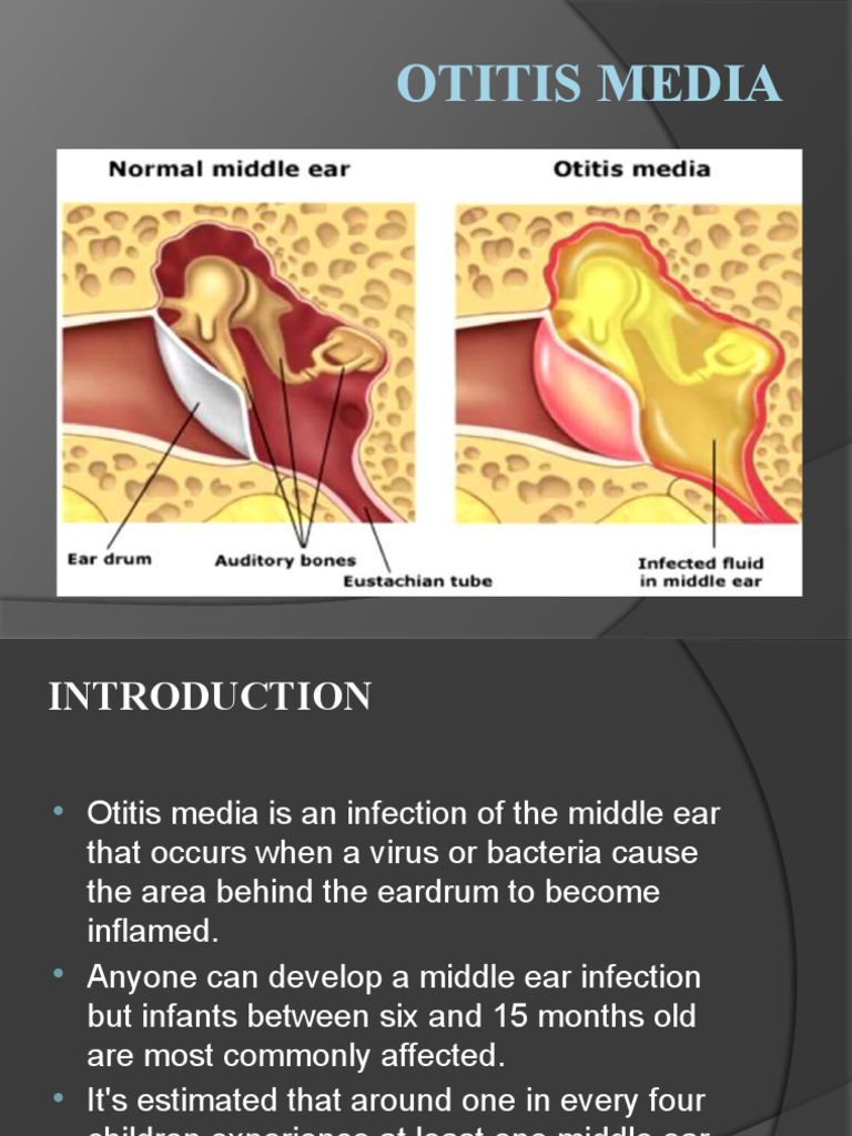 OTITIS MEDIA | PDF
