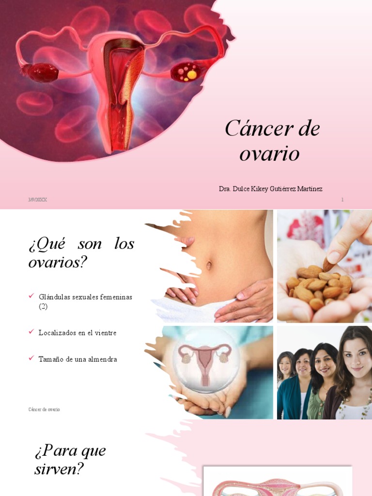 Cancer de Ovario | PDF