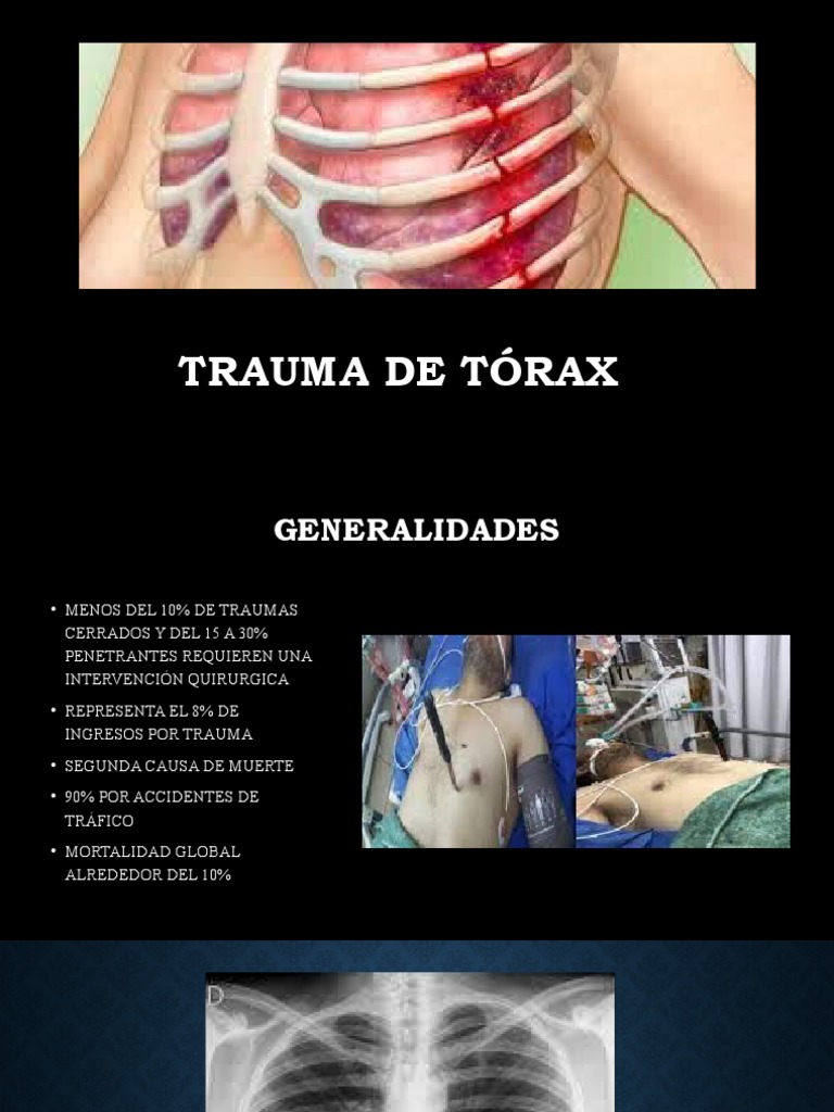Trauma de Torax | PDF | Lesión | Medicina CLINICA