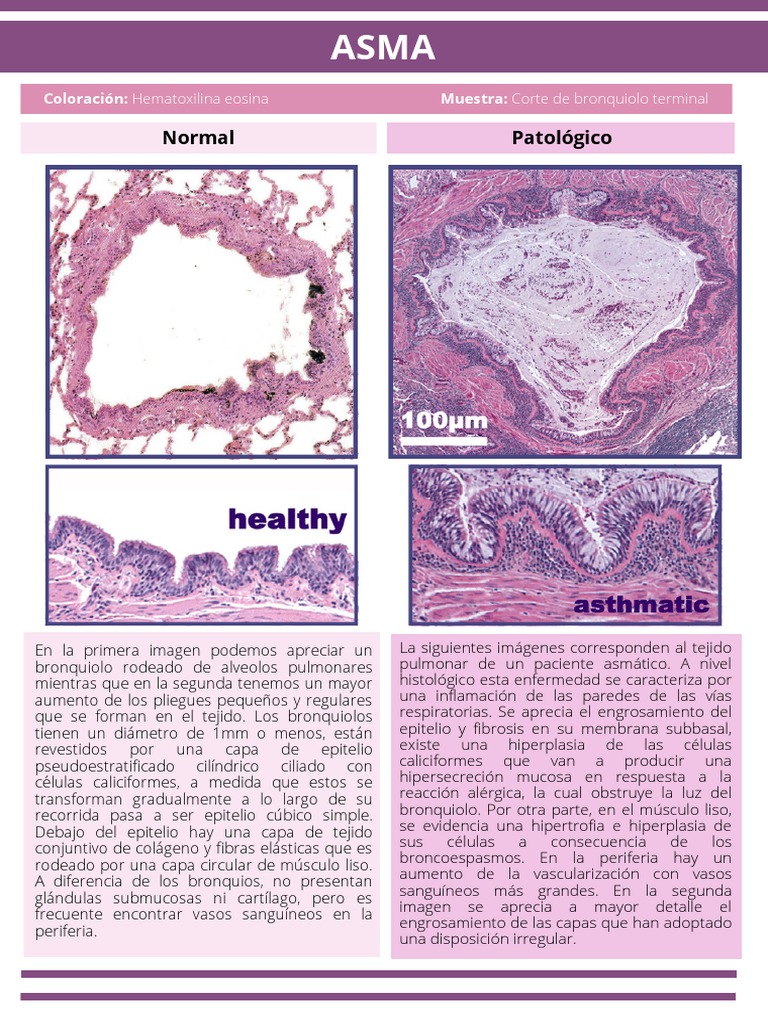 Histología en Asma | PDF