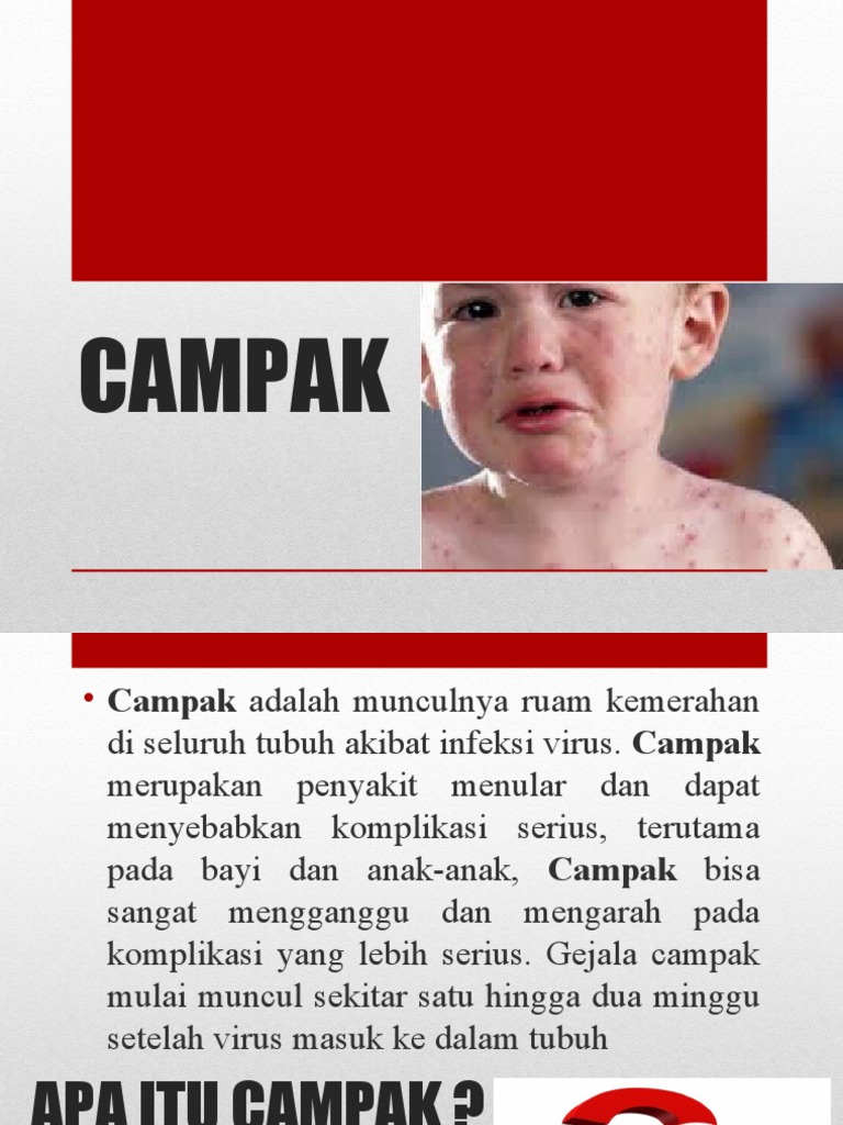Campak | PDF