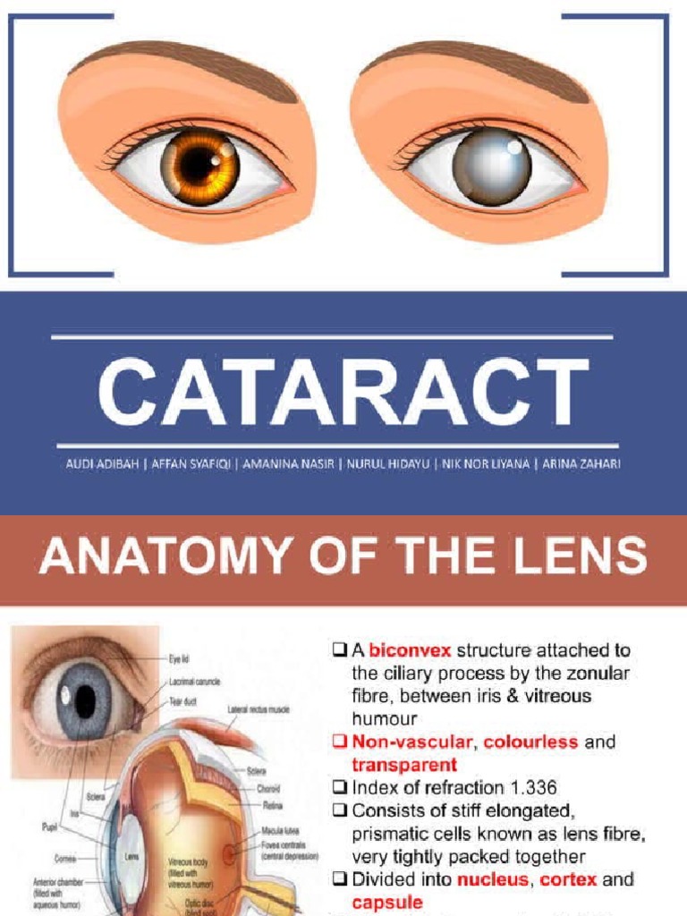 Cataract | PDF