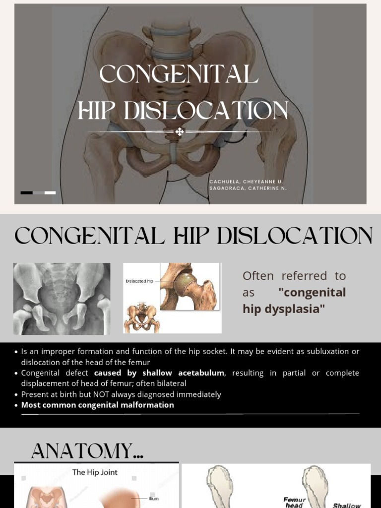Congenital-Hip-Dislocation Isu | PDF | Wellness | Science & Mathematics