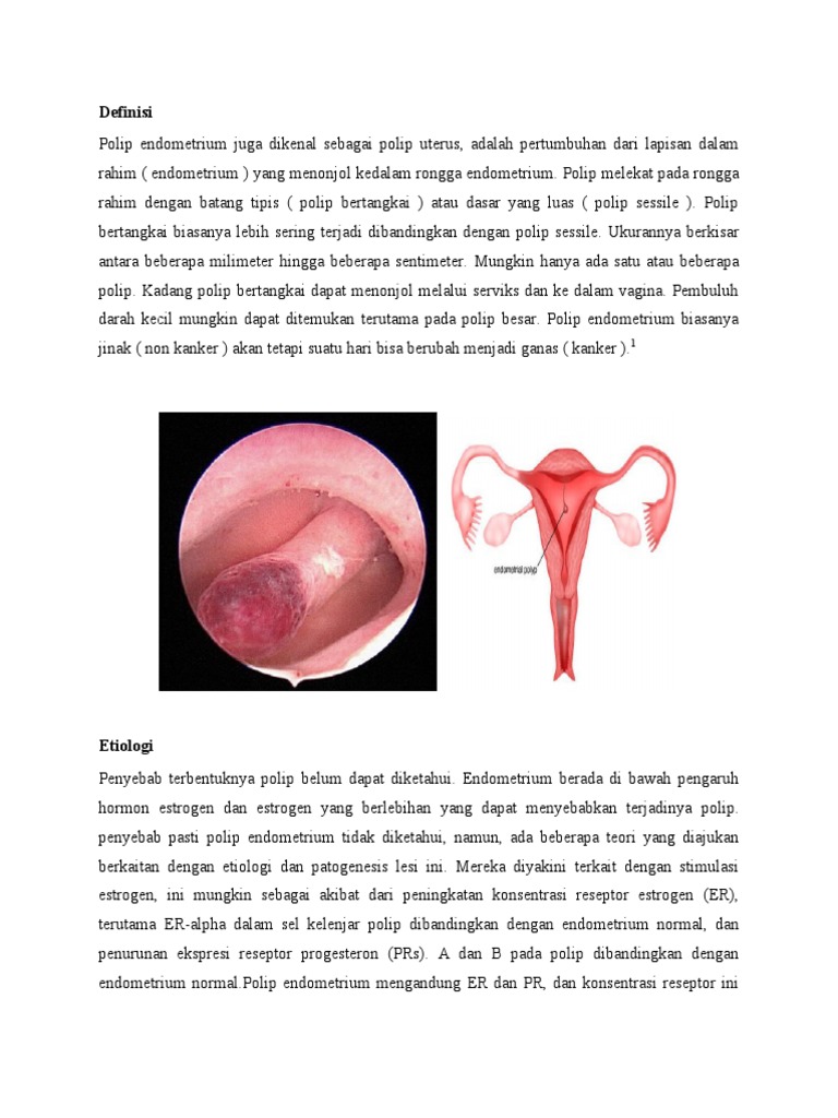 POLIP ENDOMETRIUM Sava | PDF
