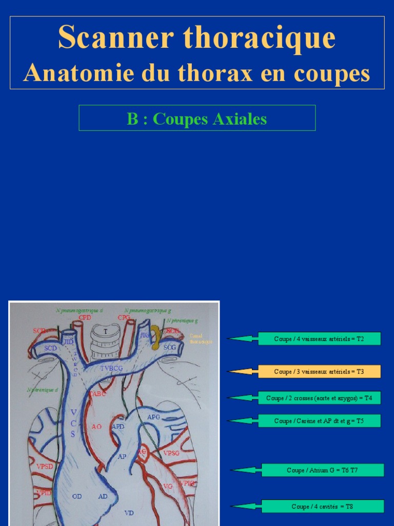 Scanner TDM Thoracique en Coupes | PDF | Aorte | Thorax