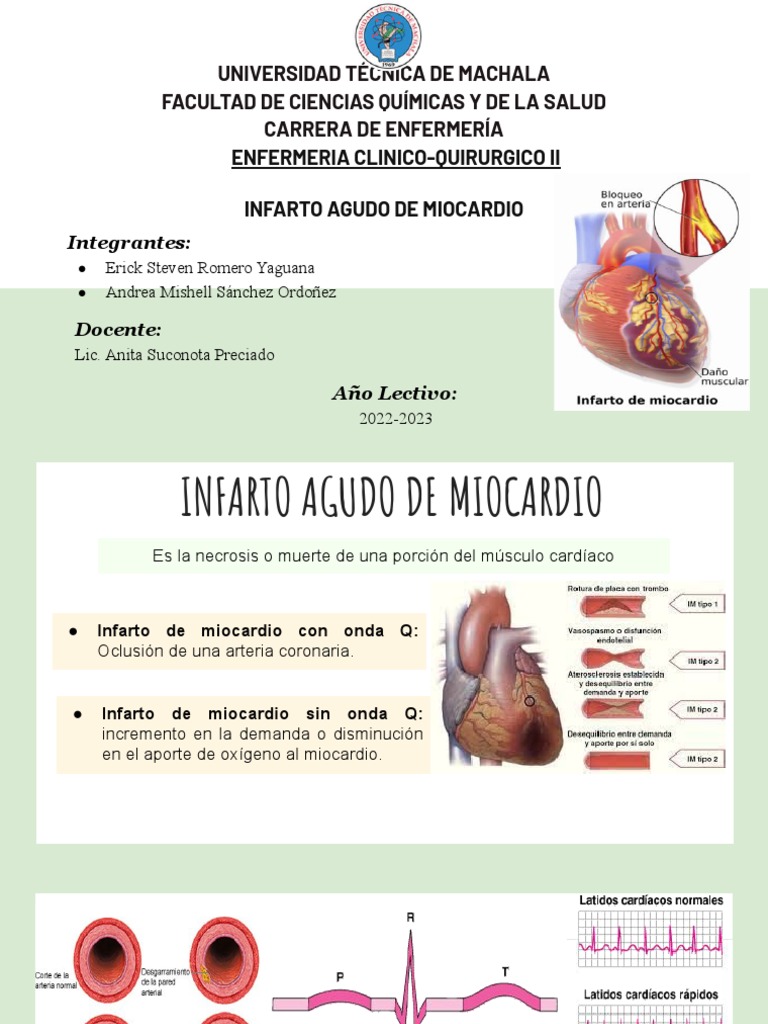 Infarto Agudo de Miocardio: Diagnóstico y Cuidados | PDF | Infarto de ...