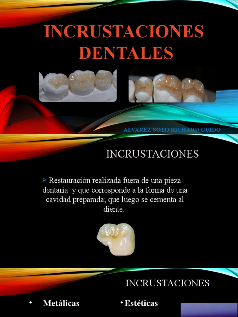 Vdocuments - MX - Incrustaciones Inlay Onlay y Overlay | PDF | Esmalte ...