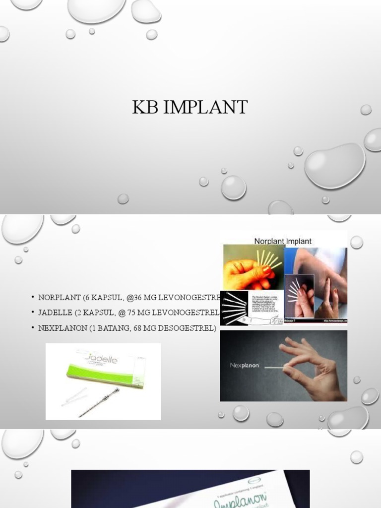 KB Implant | PDF