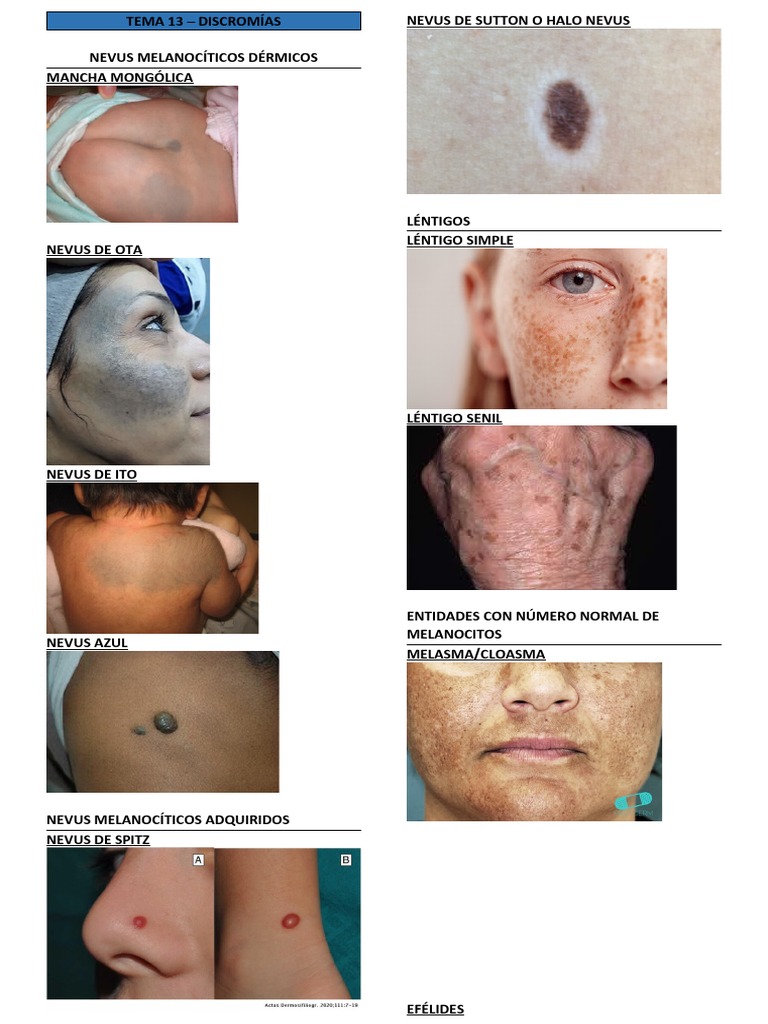 Nevus Melanocíticos Dérmicos | PDF