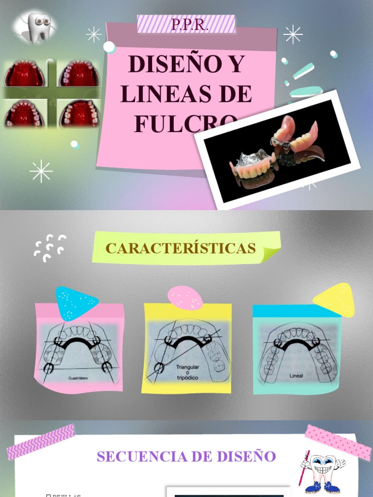 Diseño de Líneas de Fulcro en Prótesis | PDF | Dentadura postiza ...