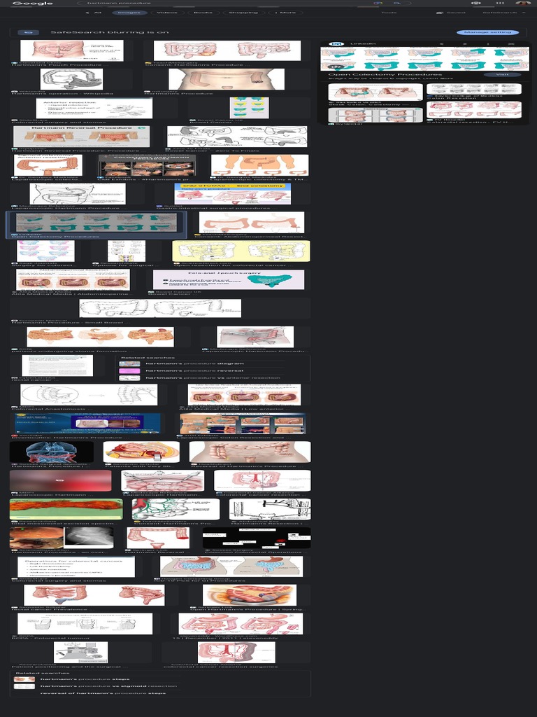 Hartmann Procedure - Google Search | PDF | Colorectal Cancer | Surgery