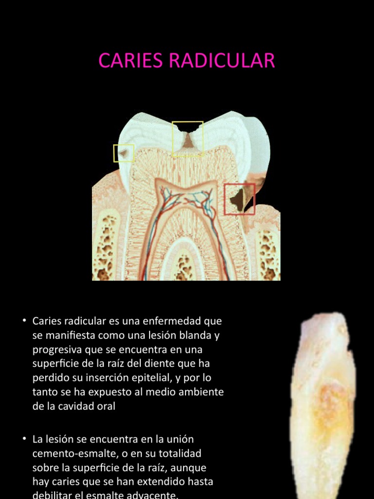 CARIES RADICULAR Apunte Unap | Descargar gratis PDF | Esmalte de ...