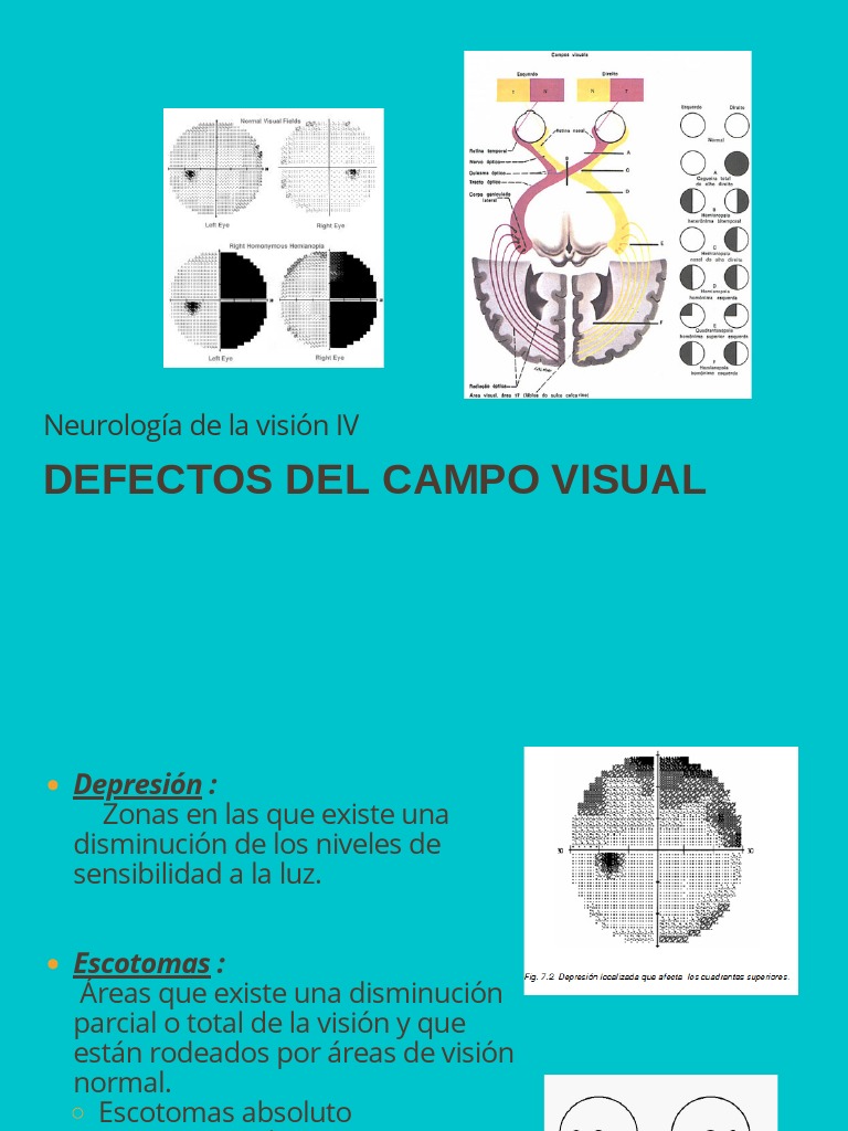 Defectos Del Campo Visual - PPTX - 20230904 - 154228 - 0000 | PDF