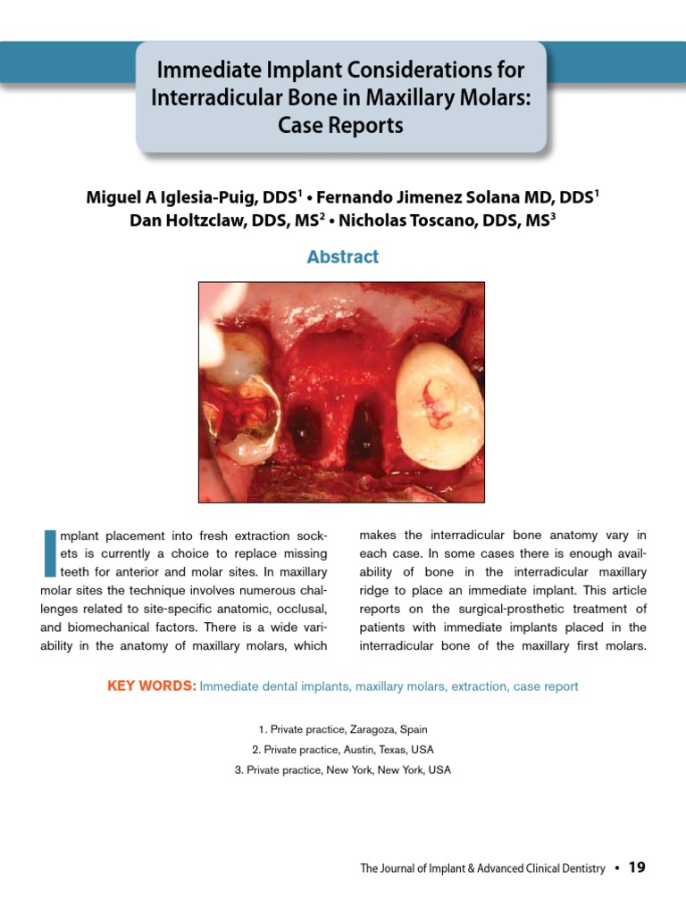 Implante Inmediato Molar Superior | PDF | Dental Implant | Dentistry