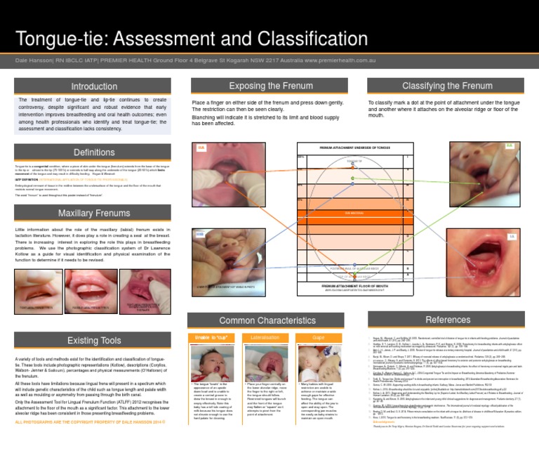 Tongue Tie - Classification - Poster - 2014 Premier Health | PDF ...