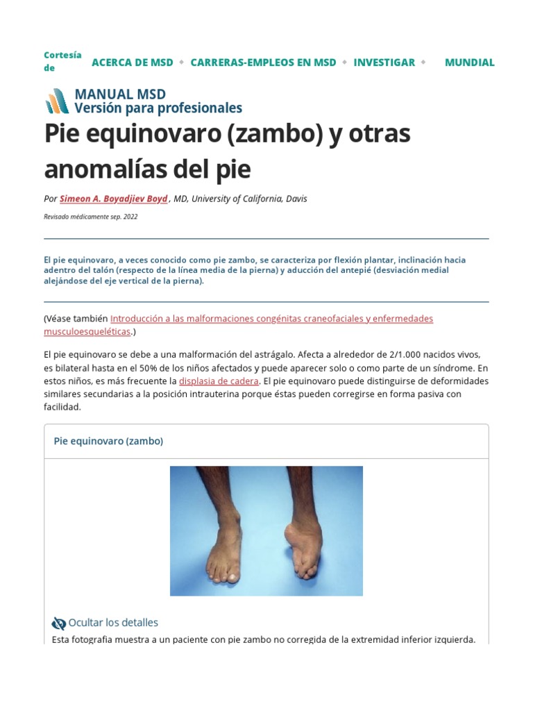 Pie Equinovaro (Zambo) y Otras Anomalías Del Pie - Pediatría - Manual ...