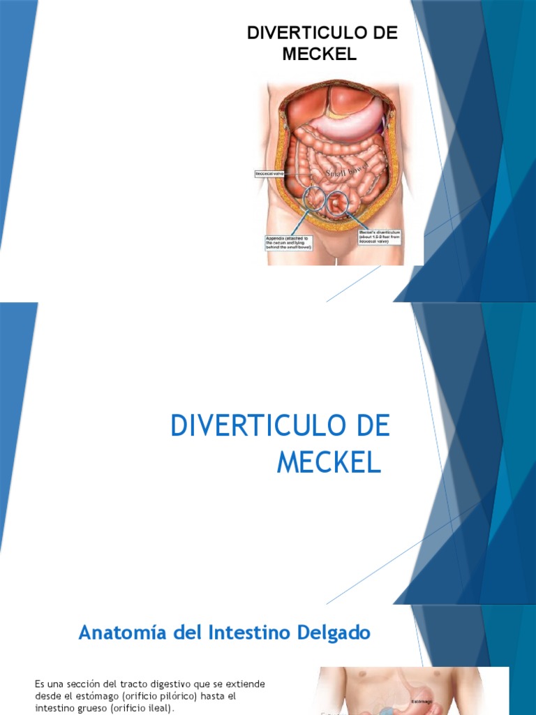 Divertículo de Meckel: Aspectos Clave | PDF | Tracto gastrointestinal ...