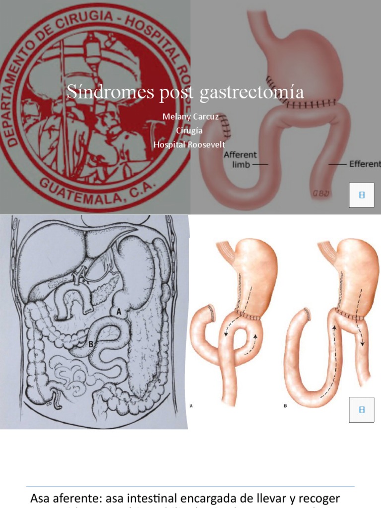 Sindromes de Asa | PDF | Endoscopia | Medicina CLINICA