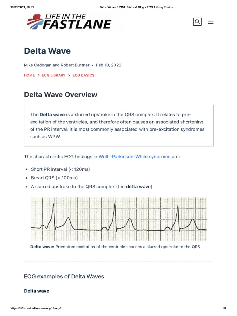 Delta Wave - LITFL Medical Blog - ECG Library Basics | PDF | Medical ...