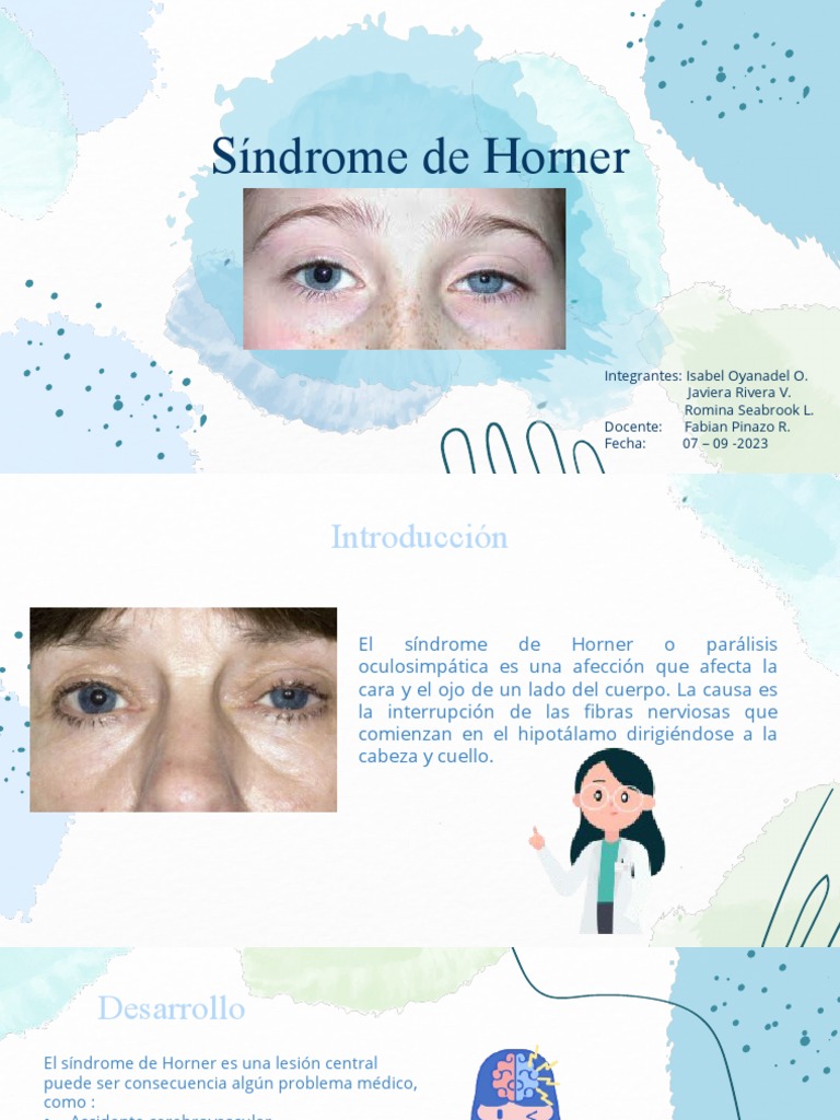 Sindrome de Horner | PDF