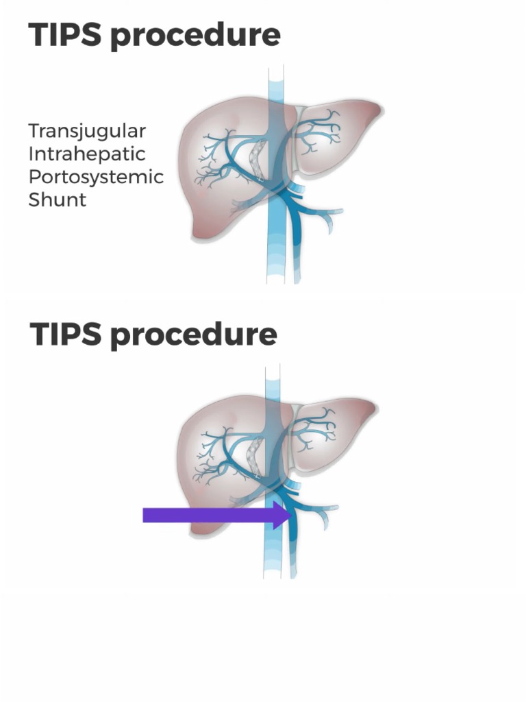 TIPS Procedure: Complications & Contraindications | PDF