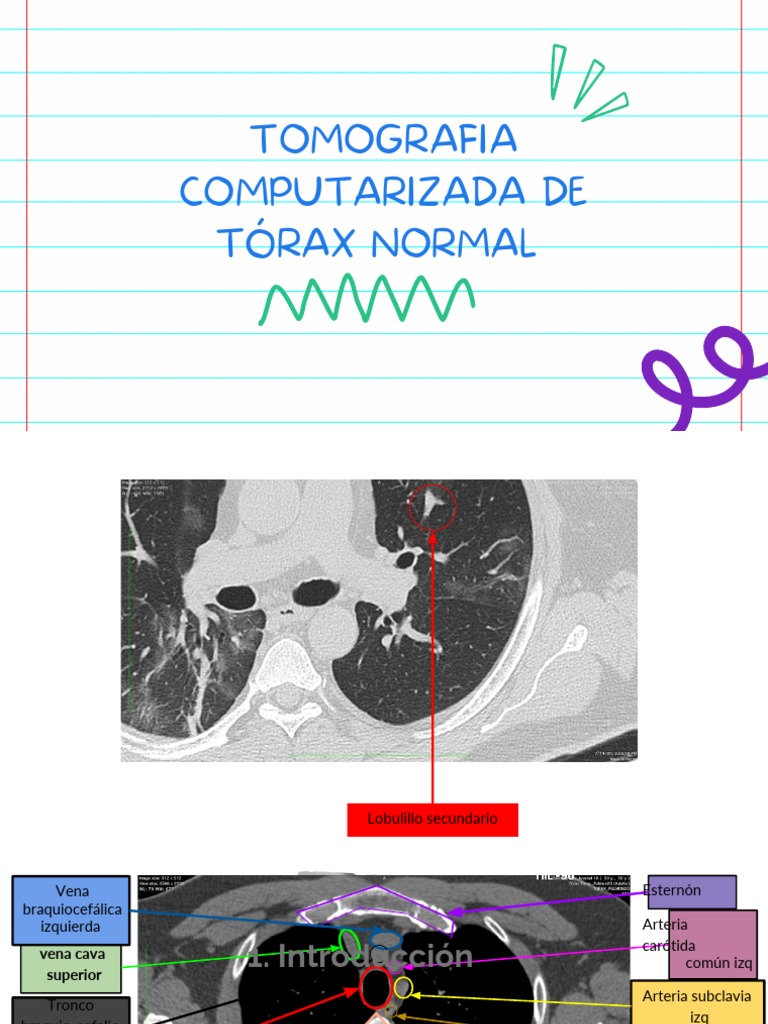 Tomografía Computarizada de Tórax Normal | PDF